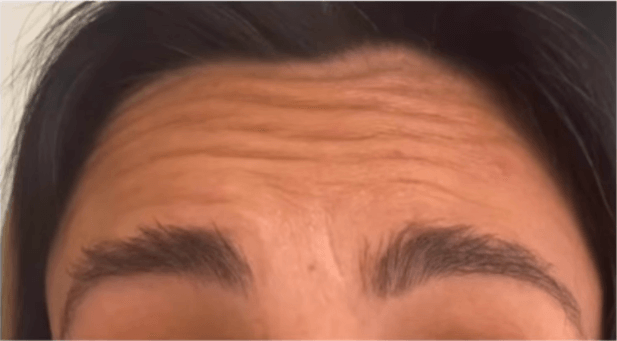 Botox Sacramento | Botox Injections - The Michele Aesthetic